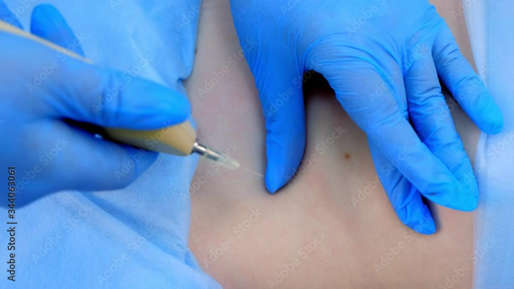 Doctor is making injection carbon dioxide in patient abdomen on ...