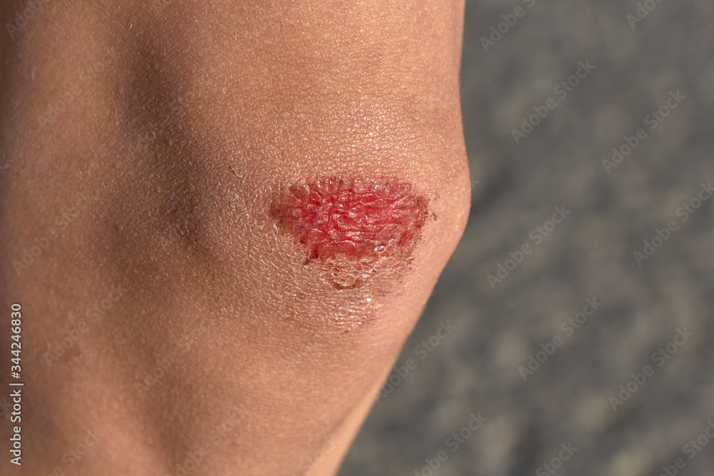 bruised wound on the knee, the boy fell and scratched his knee Stock ...