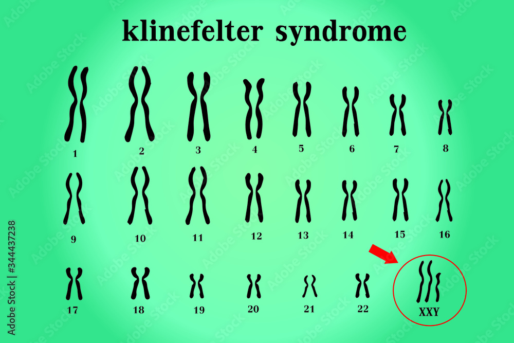 Xxy Chromosome Female