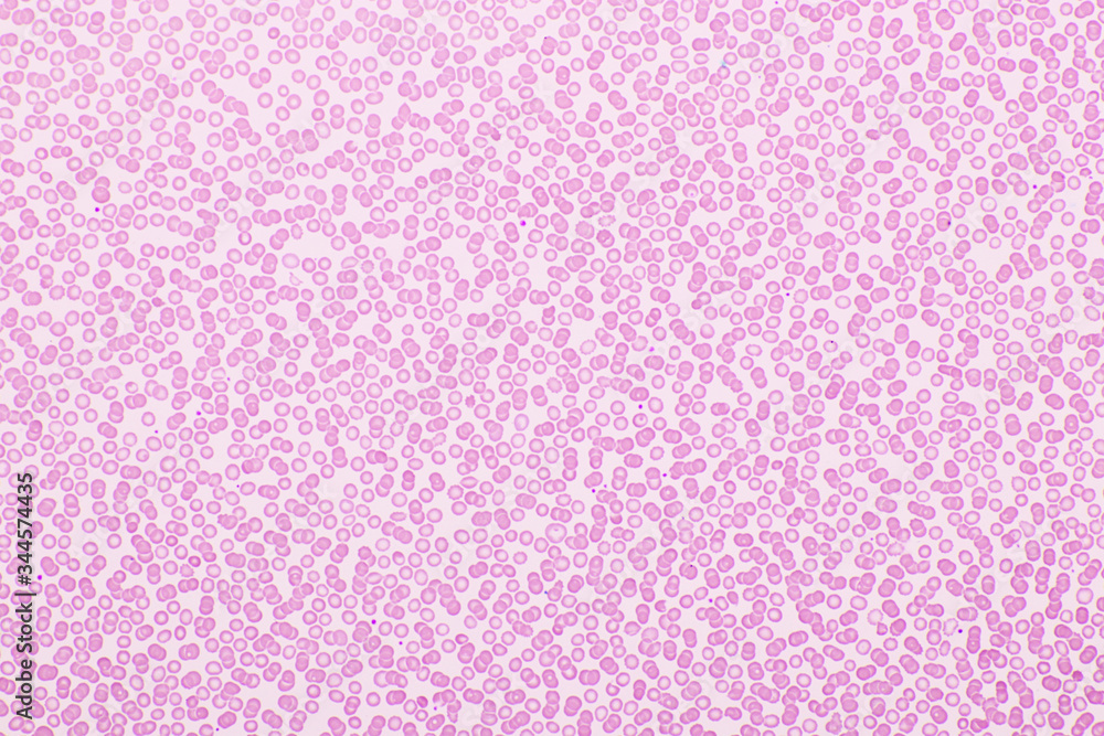 Red blood cells in blood smear, Wright-Giemsa stain, analyze by ...