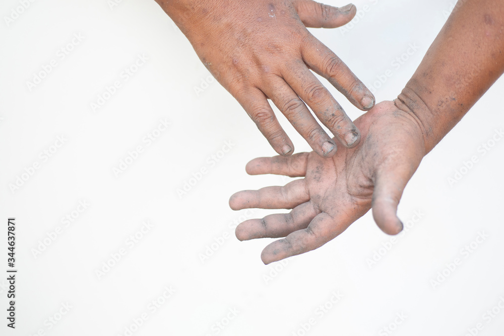 Two dirty hands of the people as the source of the pathogen. Stock ...
