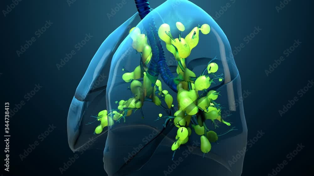 Damage lungs, severe respiratory illness, pneumonia, ARDS, acute ...