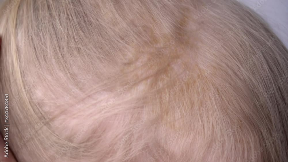 Seborrheic skin rash on the child s head, seborrheic dermatitis, close ...