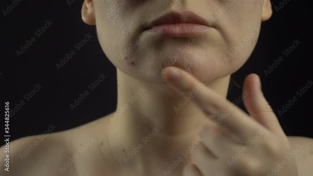 Close up of skin problems (unhealthy dry skin with acne and pimples ...