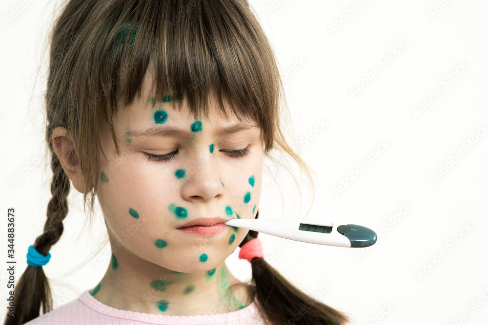 Child girl covered with green rashes on face ill with chickenpox ...