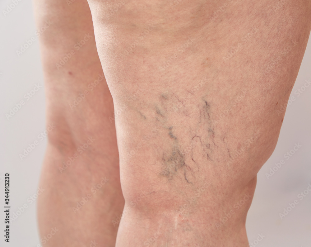 legs of a 40-year-old woman with stretch marks, cellulite and varicose ...
