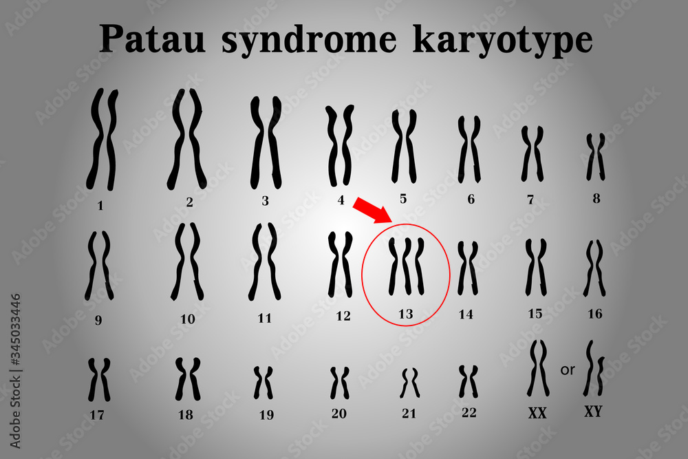 Patau syndrome karyotype is the one of chromosomal disorders that have ... Patau syndrome karyotype is the one of chromosomal disorders that have ...