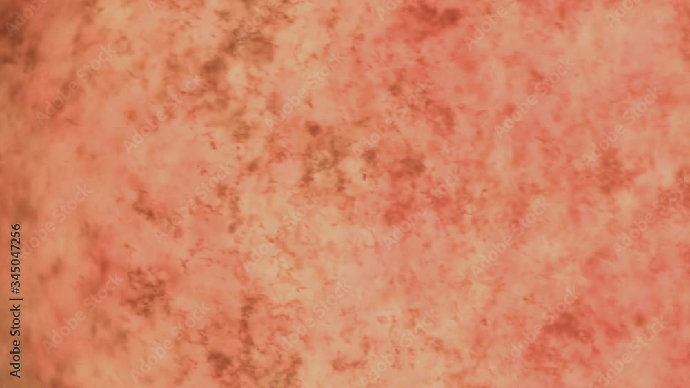 Fresh blood and insulin on microscope view. Blood smear under ...