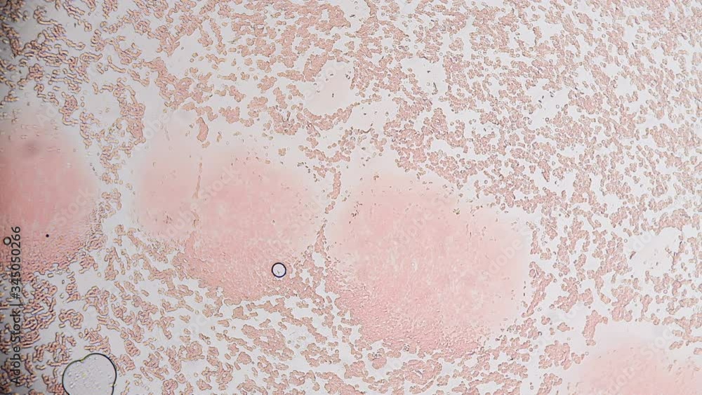 Fresh blood seen on a 100x microscope view. Blood smear under ...