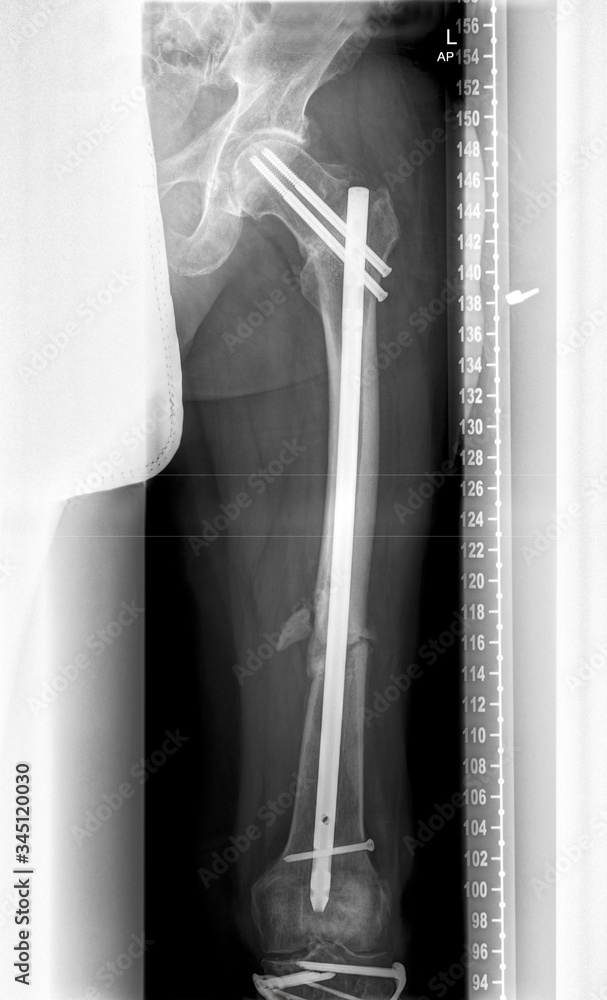 Radiographs, x-rays of a heavily injured motorcyclist with multiple ...