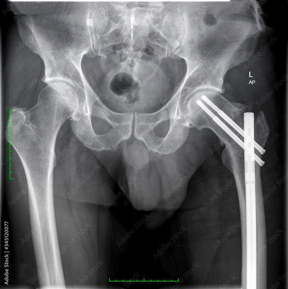 Radiographs, x-rays of a heavily injured motorcyclist with multiple ...
