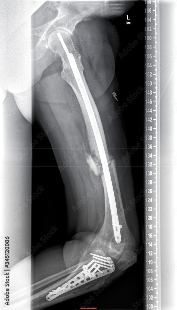 Radiographs, x-rays of a heavily injured motorcyclist with multiple ...