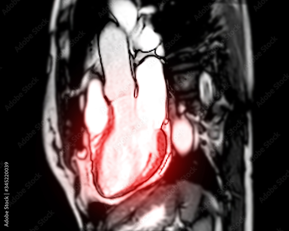 MRI heart or Cardiac MRI ( magnetic resonance imaging ) of heart LVOT ...