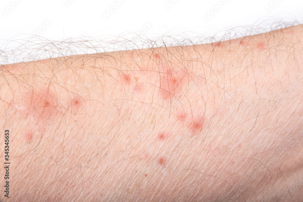 Skin disease rash on a man arm Stock Photo | Adobe Stock