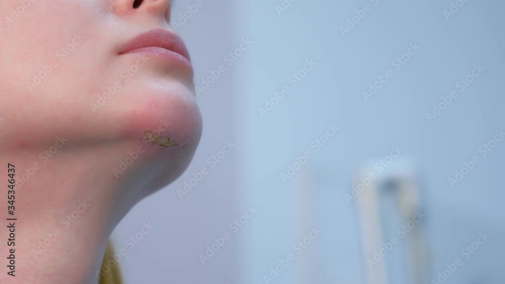 Woman's chin with wound and burning skin after laser removal of scar ...