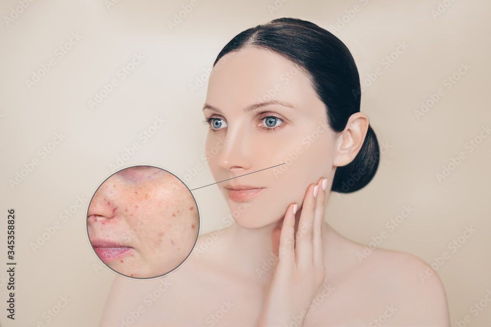 Beautiful woman with a problem vascular skin. Photo before and after ...