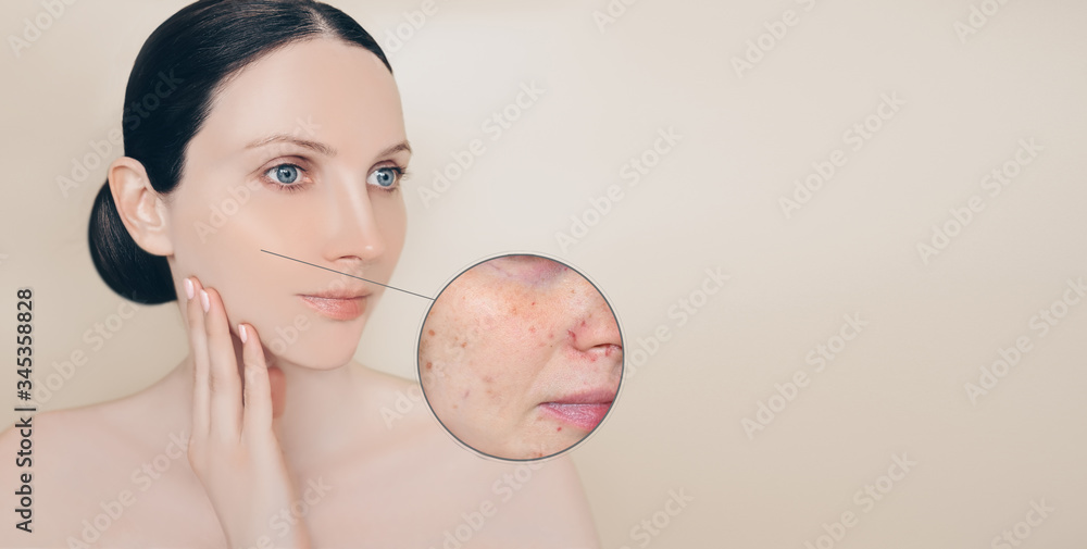 Beautiful woman with a problem vascular skin. Photo before and after ...