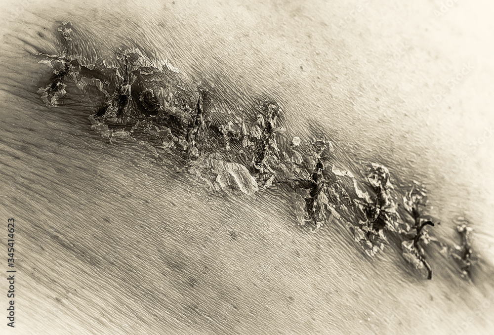 Macro with a close approximation, black and white. Medical scar after ...