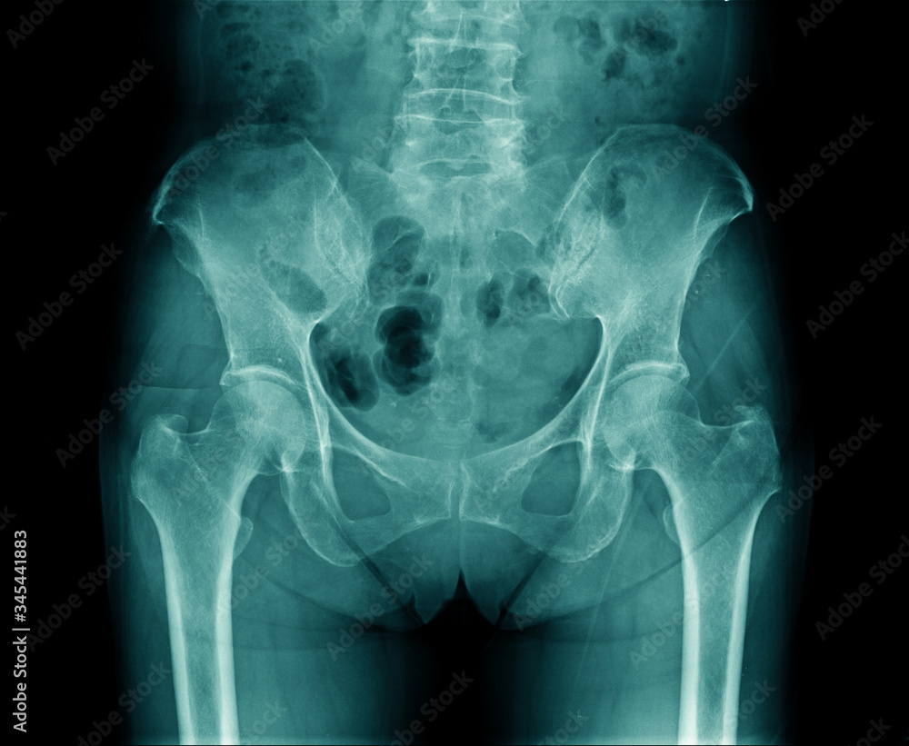x-ray pelvic bone and part of lumbar bone with hip joint in blue tone ...