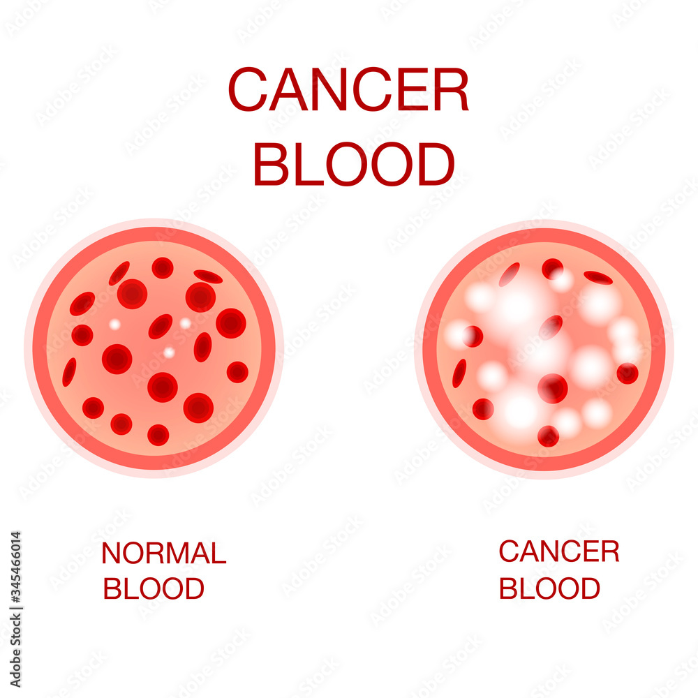Infographic image of leukemia. Leukaemia disease awareness.Realistic ...