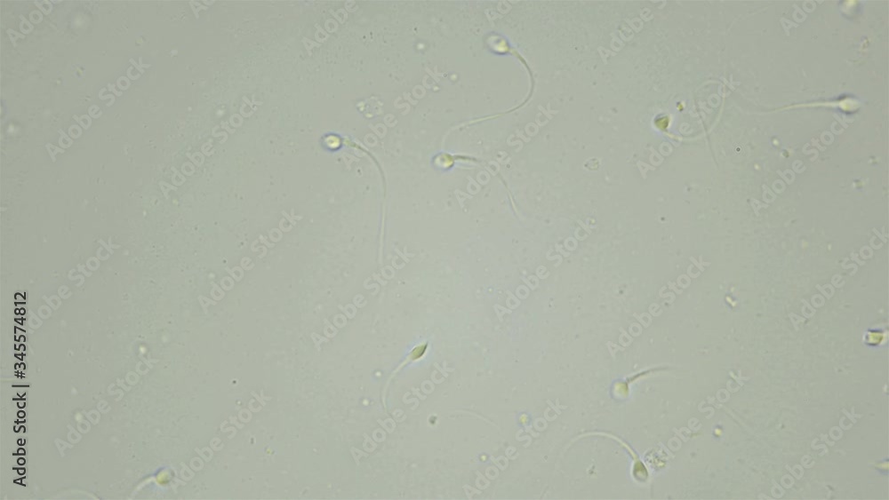 Human sperm under a microscope (spermatozoa), consists of sperm and ...