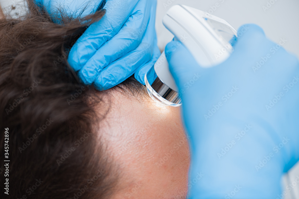 Trichoscopy of hair and scalp closeup. Trichoscope in the hands of a ...