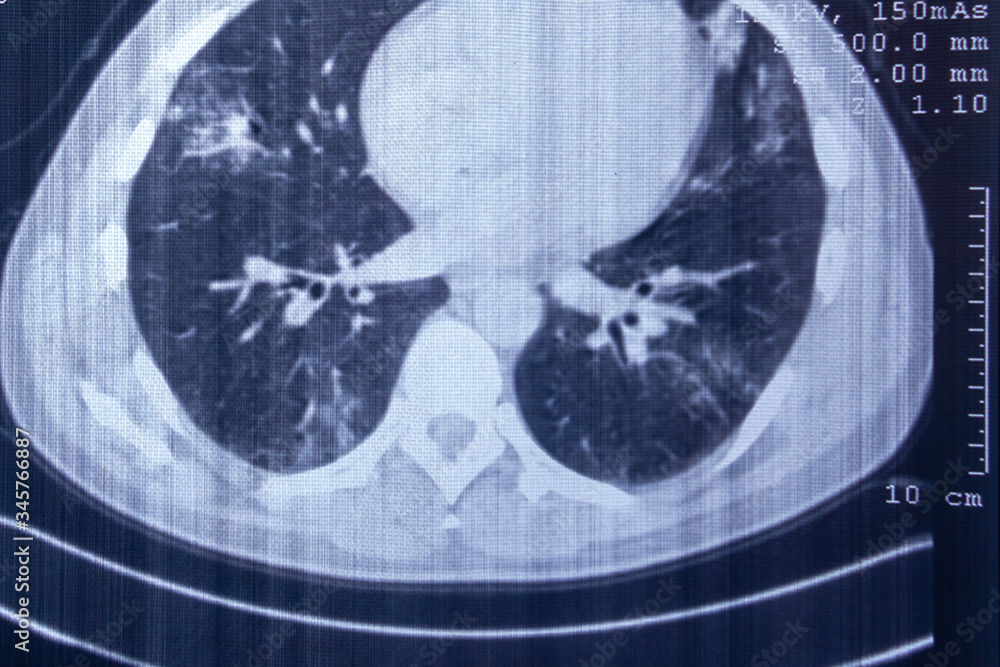 X-ray of pneumonia-affected lungs. CT scan. Stock Photo | Adobe Stock