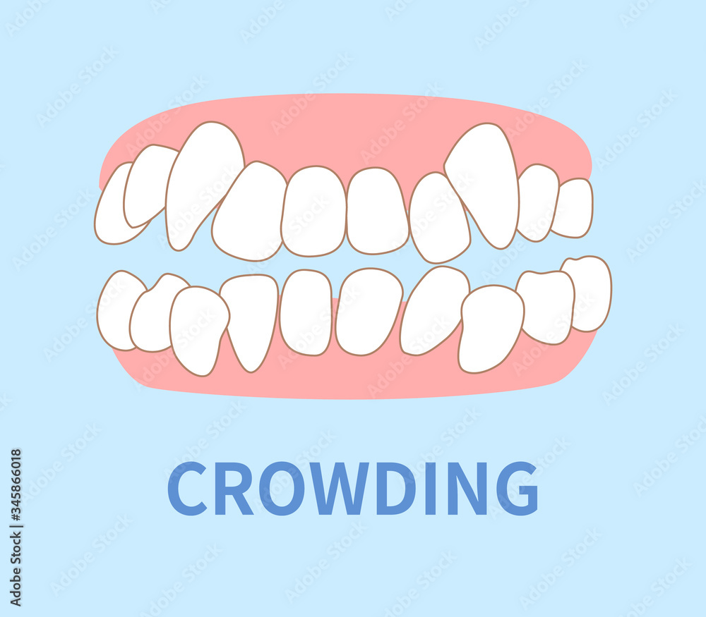 orthodontics illustrations ; crowding tooth Stock Vector | Adobe Stock