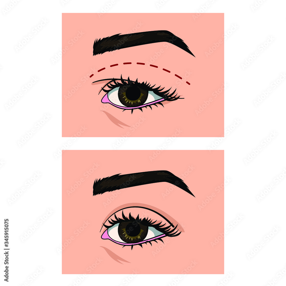 Eyes comparison. Eyelids before and after surgery. Blepharoplasty ...