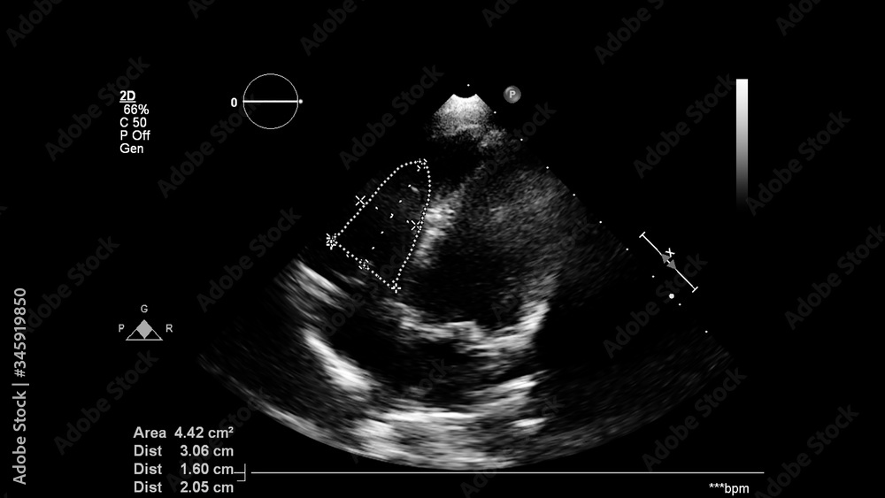 Image of the heart in gray-scale mode during transesophageal ultrasound ...