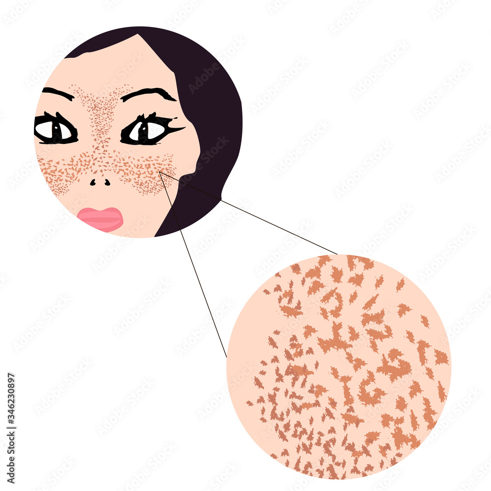 Freckles on the face. Pigmentation on the skin. A pigmented spot on the ...