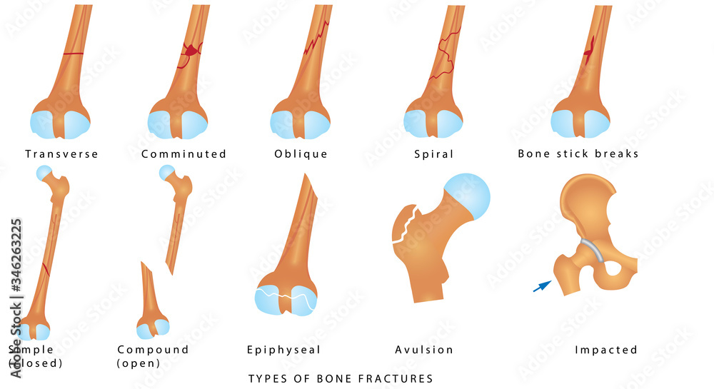 Types of Bone Fractures. Different kinds of fractures. Descriptive ... Types of Bone Fractures. Different kinds of fractures. Descriptive ...