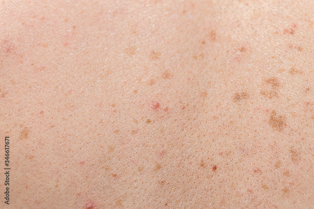 Naklejka Close-up of large rashes or smallpox on the skin of an adult ...