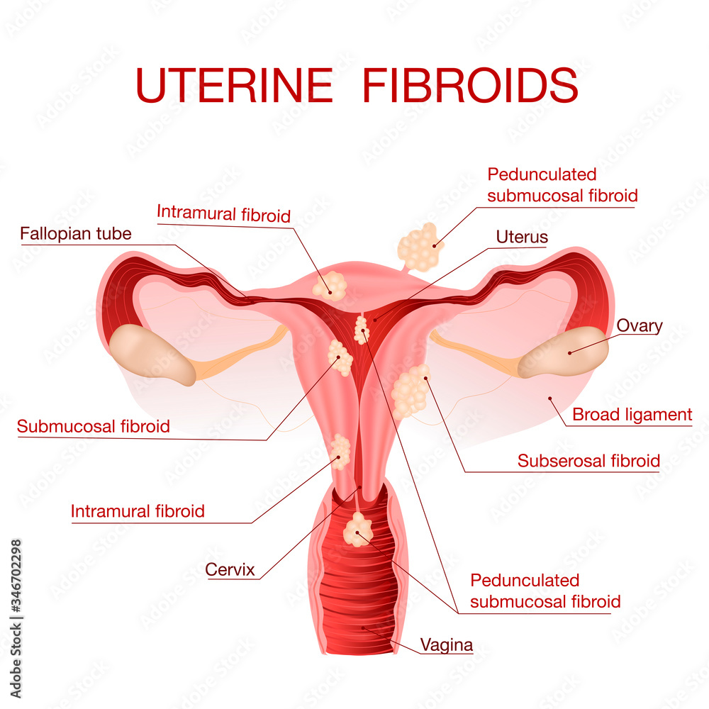 Uterine Fibroids A Schematic Illustration Of The Uterus Female