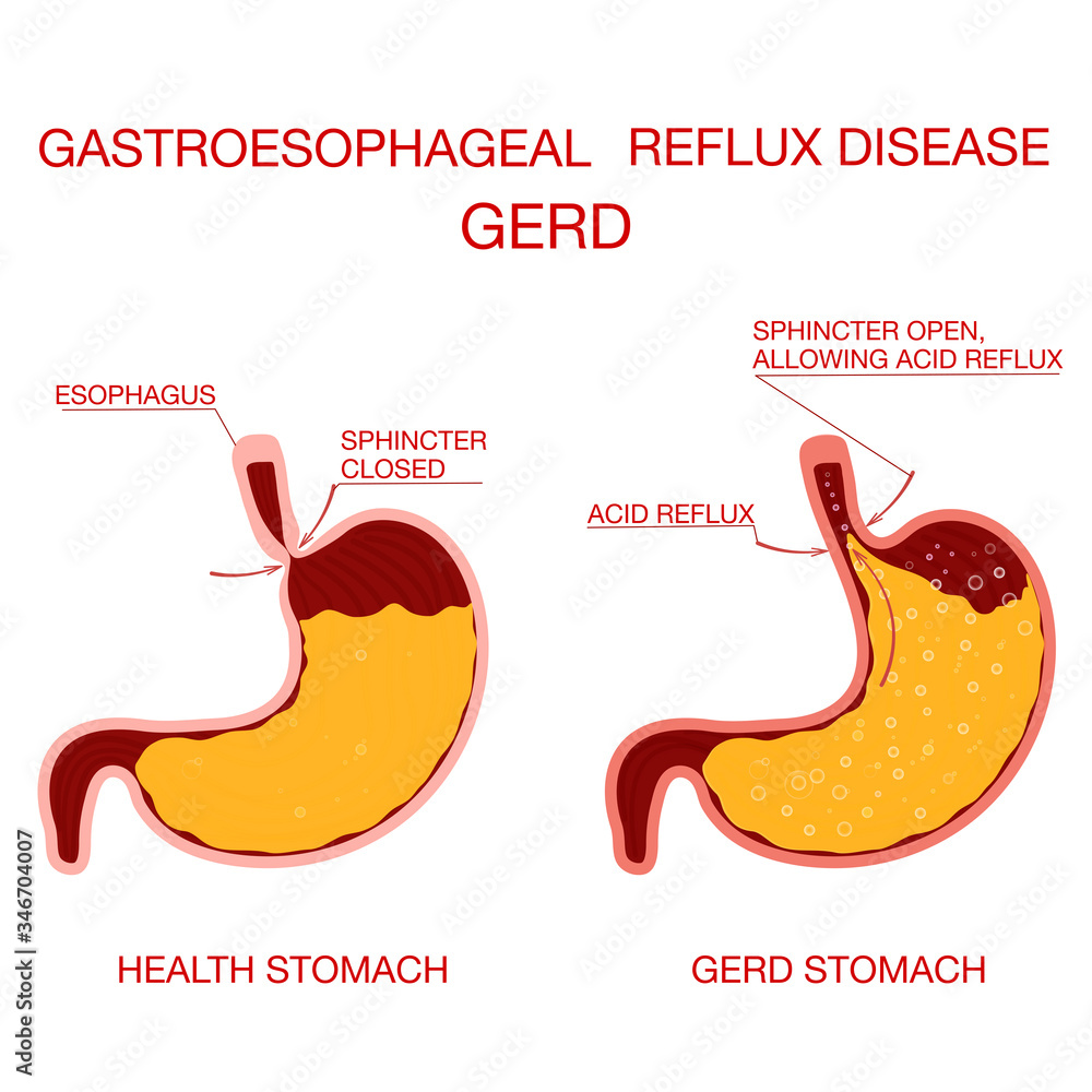 Heartburn and Gastroesophageal Reflux Disease GERD. Stomach acid moving ...