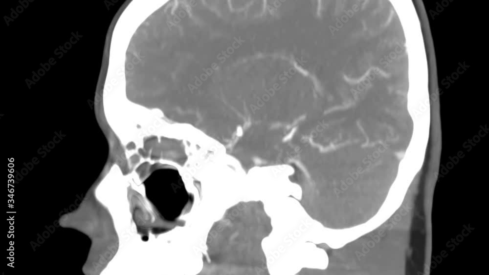 Angio Angiography MRI brain scan, Side view. Computed Tomography of the ...