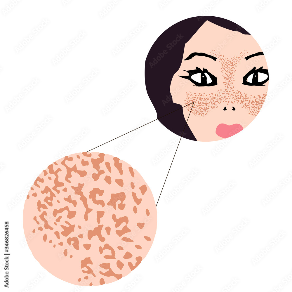 Freckles on the face. Pigmentation on the skin. A pigmented spot on the ...