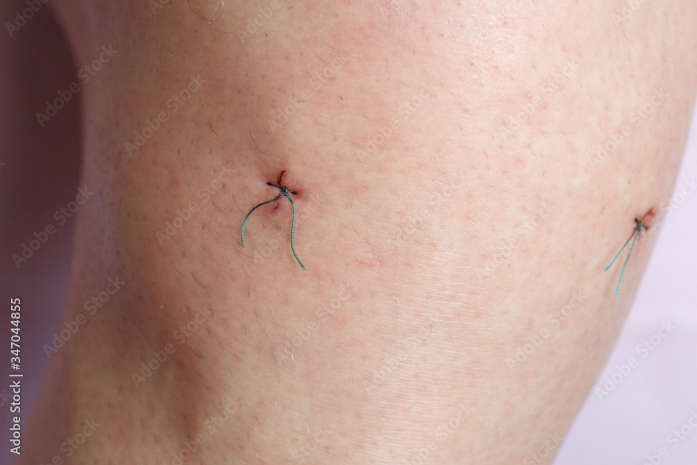 Arthroscopy or arthroscopic meniscectomy surgical suture of a man's ...