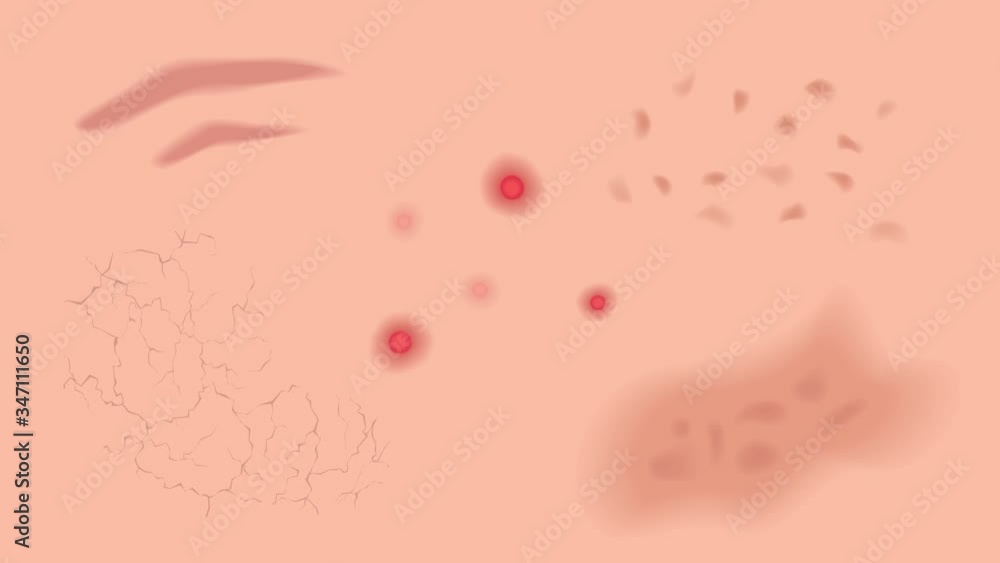 pus acne pimple freckle chloasma burn aging dry and ringworm graphic ...