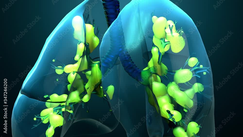 Damage lungs, severe respiratory illness, pneumonia, ARDS, acute ...