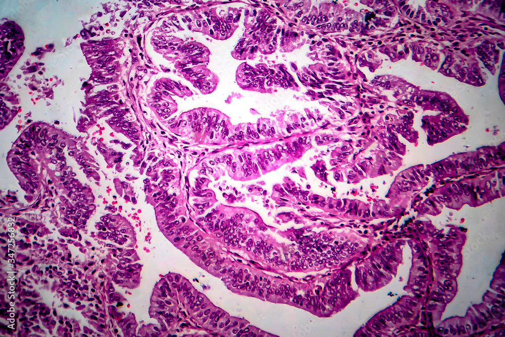 Endometrial adenocarcinoma, light micrograph, photo under microscope ...