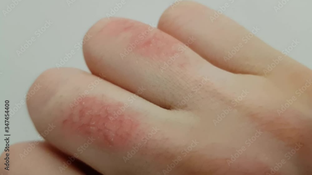 Severe dermatological skin damage. Dry red rash on the phalanges of the ...