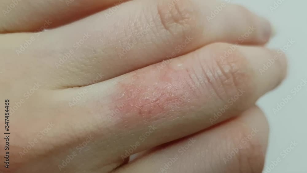 Medical review of the patient's hand by a dermatologist: dry eczema ...