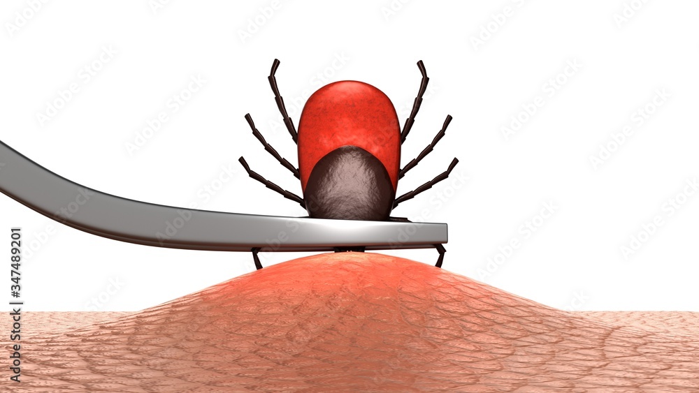 How to remove a tick. The correct way using forceps. 3D-rendering ...