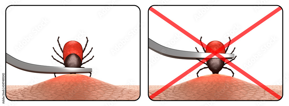 How to remove a tick. The correct way using forceps. 3D-rendering ...