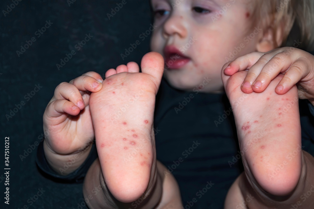 Chickenpox disease. Baby has acne on the feet. Chickenpox virus ...