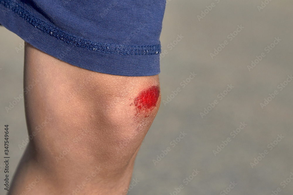 bruised wound on the knee, the boy fell and scratched his knee Stock ...