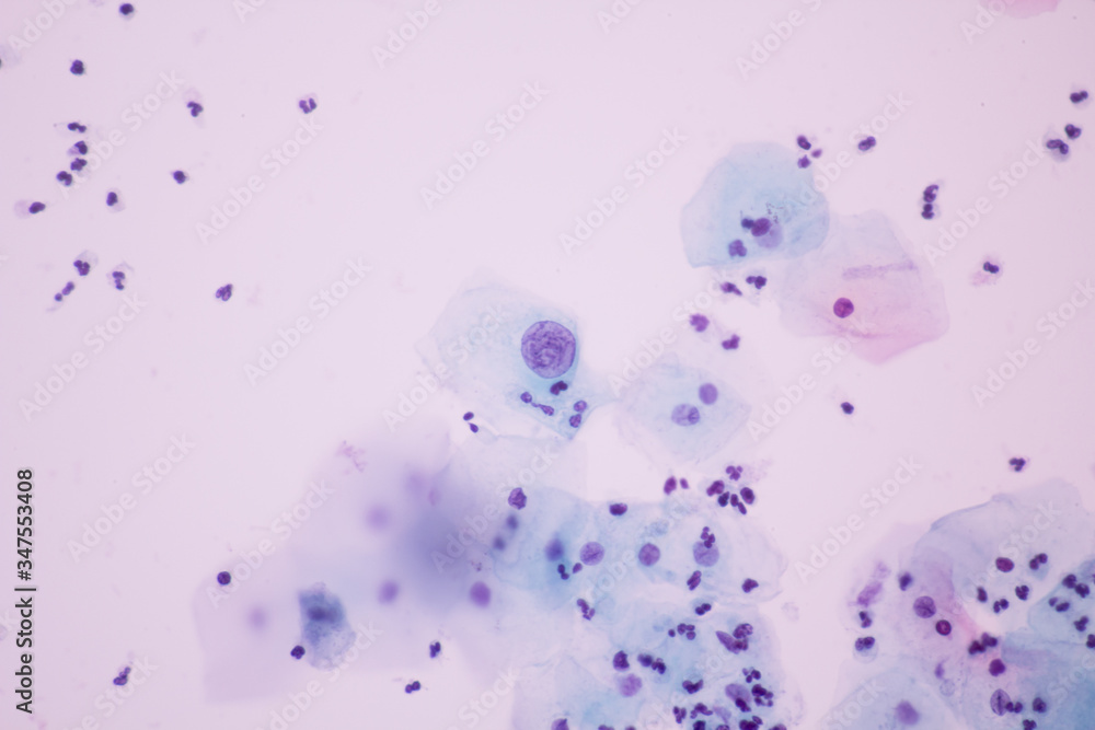View in microscopic of Abnormal human cervical cells.Squamous ...
