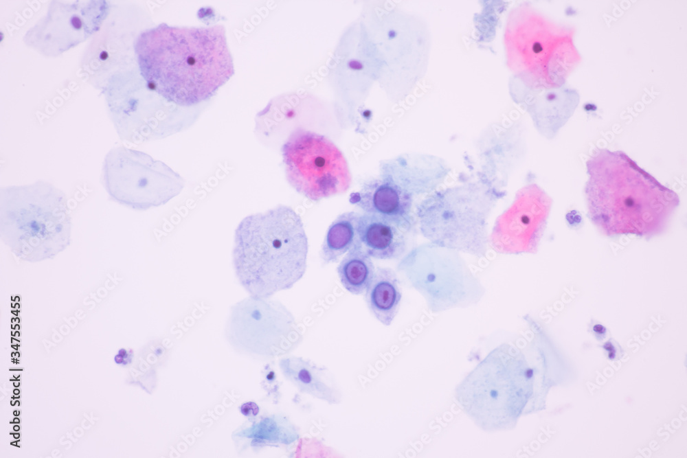 Foto de Image from microscopic of herpes simplex virus infection show ...