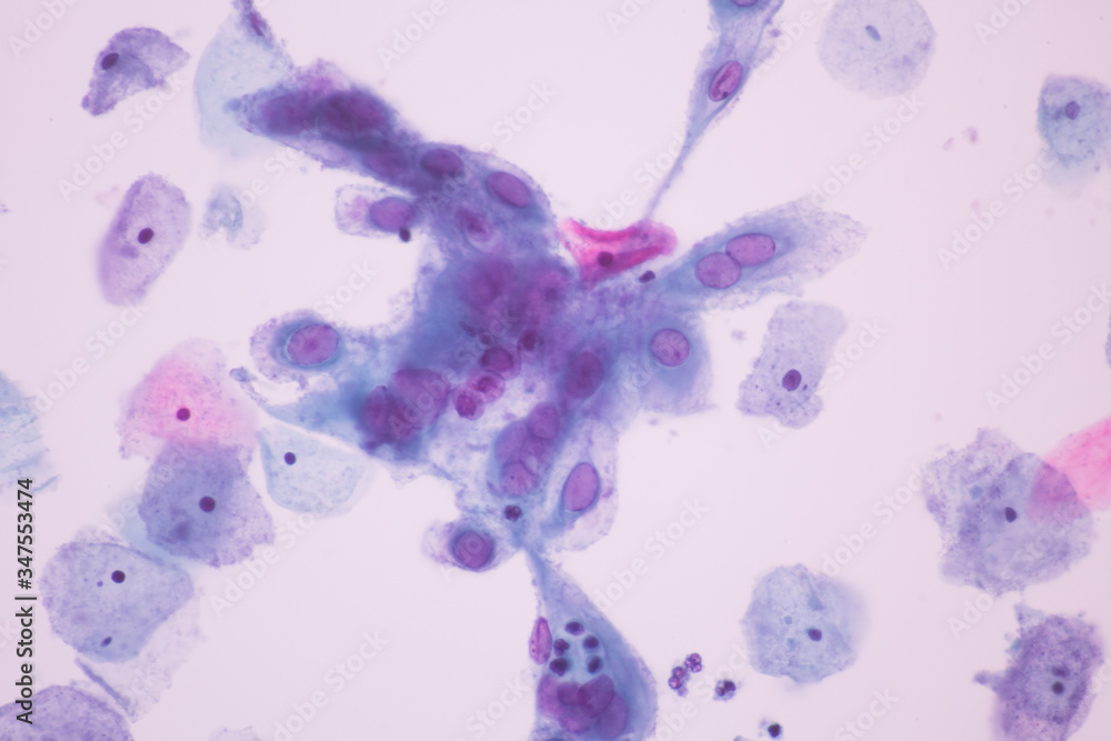 Foto de Image from microscopic of herpes simplex virus infection show ...